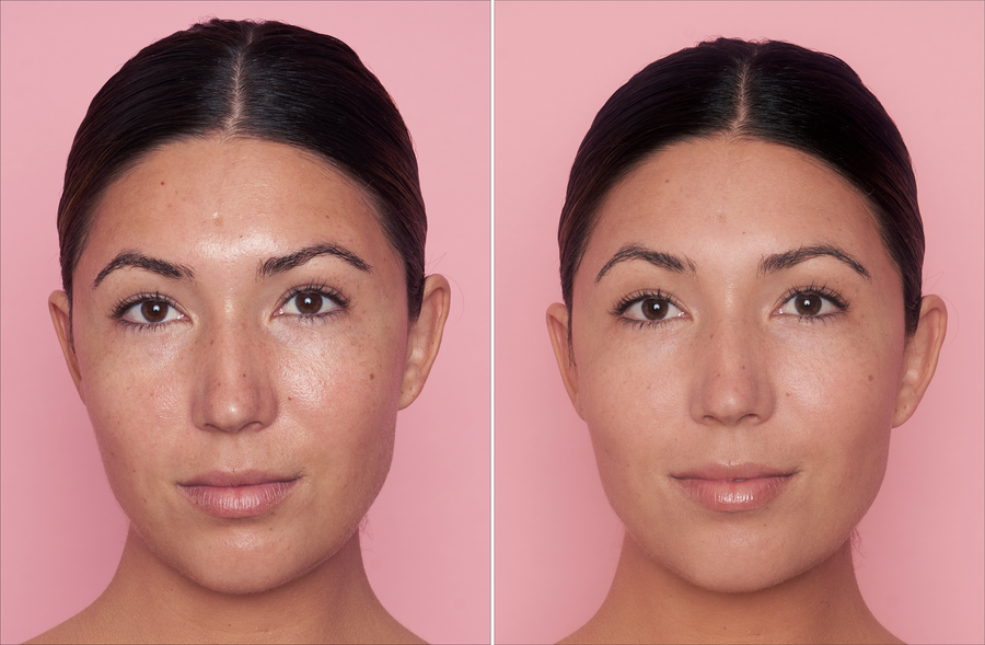 Thin Lips/Lip Wrinkles – freezeframe-uk